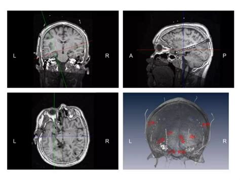 Ictal Eeg Source Imaging Pptx Brain And Nervous System Disorders Diseases And Conditions