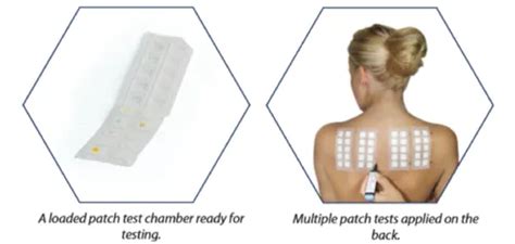 Patch Testing Dermatologist In Holmdel Middletown Tinton Falls Nj