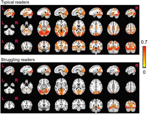 Functional Connectivity Maps In Typical And Struggling Readers P