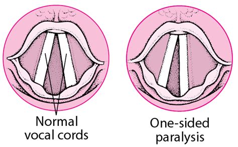 Vocal Cord Paralysis Ear Nose And Throat Disorders Msd Manual