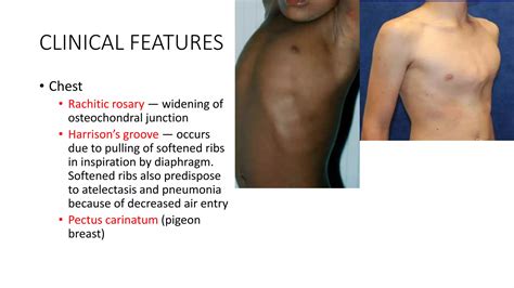 Rickets And Osteomalacia Pptx