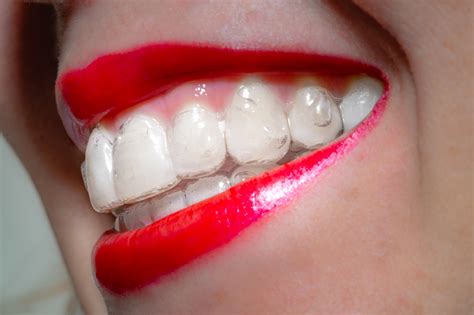 Invisalign FAQ How Does Invisalign Work And Is It Right For You