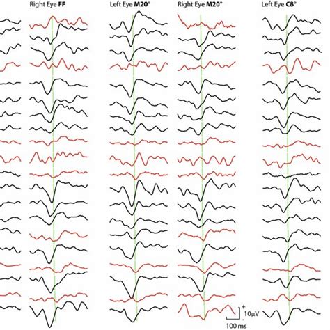 Monocular Pattern Reversal Veps 40′ And 20′ Are Plotted In Four Download Scientific Diagram
