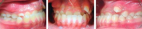 Figure 4 From Camouflage Treatment Of A Skeletal Class Iii Malocclusion With Tooth Transposition