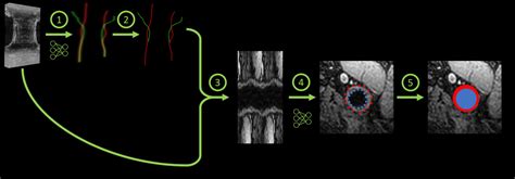 carotid artery vessel wall segmentation team wall e algorithms