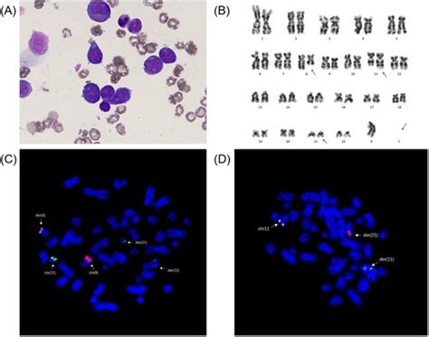 Full Article A Runx1 Runx1t1 Aml With A Simultaneous False Positive