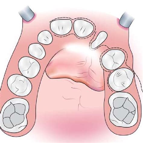 Pdf Alveolar Bone Grafting