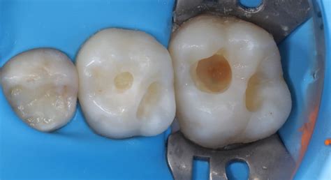 Treatment Of Dentin Caries In Permanent And Deciduous Teeth сases Of The Polar Bear General