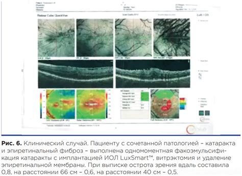 Рис 6 Клинический случай Пациенту с сочетанной патологией катарак…