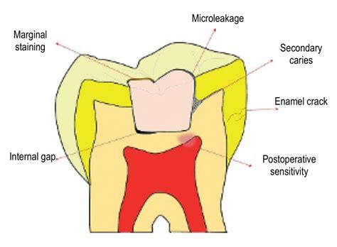 How Heated Composites Can Lead To Significantly Less Microleakage In Dental Restorations
