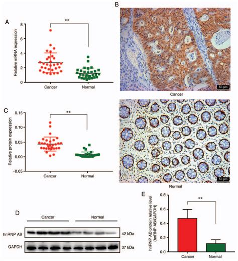 Hnrnp Ab Mrna And Protein Expression Is Upregulated In Crc Tissues A Download Scientific