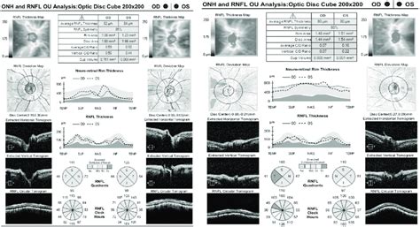 Comparison Of Retinal Nerve Fiber Length Rnfl Analysis Results Of A Download Scientific
