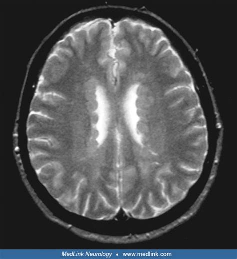 Periventricular Nodular Heterotopia Medlink Neurology