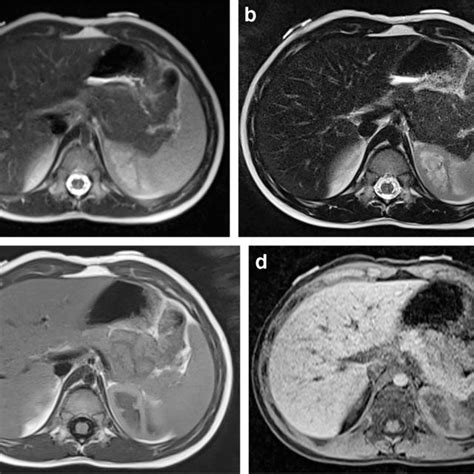 Striated Nephrogram As A Normal Variant In A 12 Year Old Girl