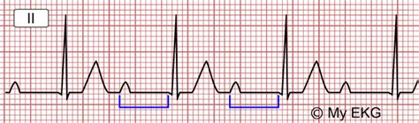 Pr Interval