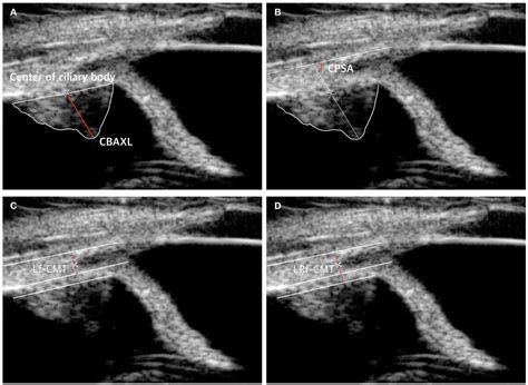 Frontiers Ultrasound Biomicroscopy Analysis Of Ciliary Muscle