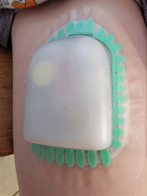 Omnipod Eros And Dash Clear Overlay Tape Bundles Pod Tape Etsy