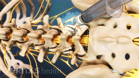 Facet Joint Injection Procedure