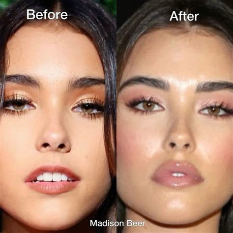 Madison Beer Before And After Plastic Surgery In 2024 Face Plastic