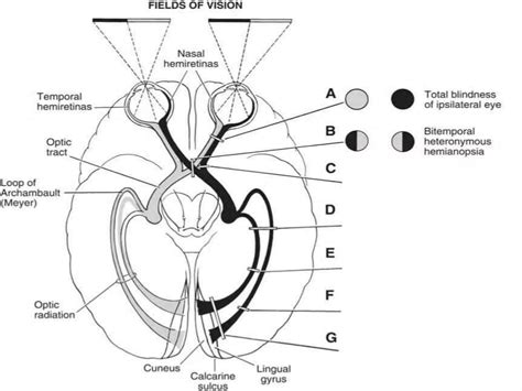 Visual Pathway And Lesions Pptx