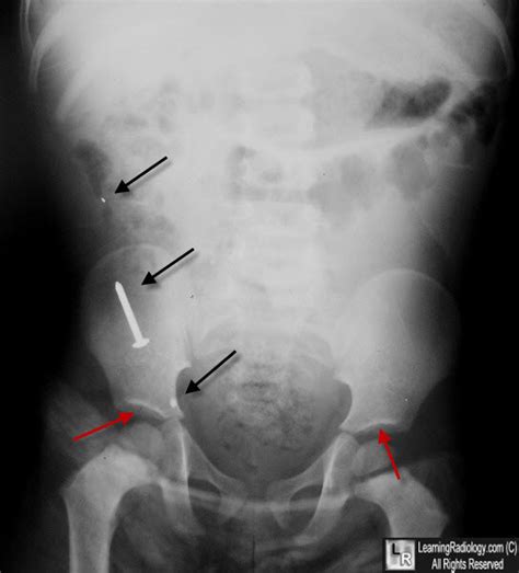 Learning Radiology Lead Poisoning Plumbism Intoxication Ingestion Pica