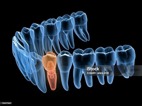 임플란트 엑스레이 보기로 조발치 치아 회복 인간의 치아와 의치 개념의 의학적으로 정확한 3d 그림 건강관리와 의술에 대한 스톡 사진 및 기타 이미지 Istock