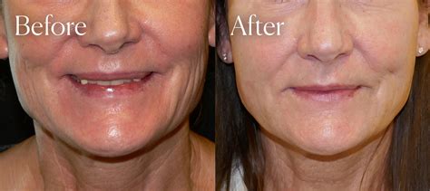 Dimpleplasty Before And After Denver Co Shah Aesthetic Surgery