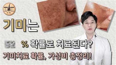 기미는 확률로 치료된다 안 보면 수백만 원 손해 보는 기미 치료 종류 비용 의사가 알려주는 가성비 순위 기미