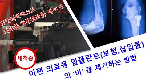 드라이아이스세척 의료용 임플란트의 버 제거디버링 바테크드라이아이스세척기 네이버 Tv