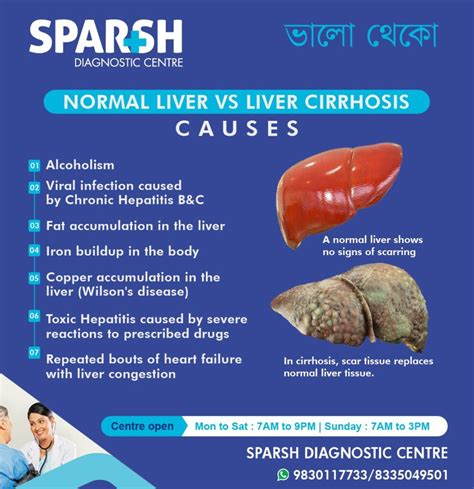 Liver Cirrhosis Sparsh Diagnostic Center