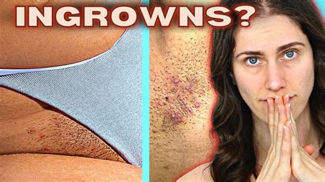 Ingrown Pubic Hair Hard Lump Under Skin