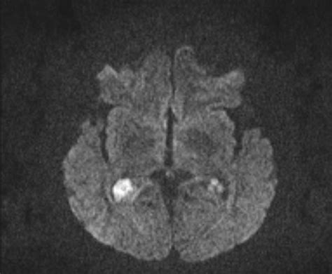 Xanthogranuloma Of The Choroid Plexus Image