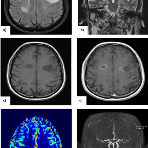 A B Brain Mri 14 06 2017 Showing White Matter Lesions Download Scientific Diagram