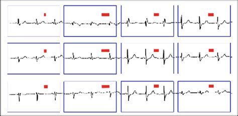 Ecg Lead Segmentation Download Scientific Diagram