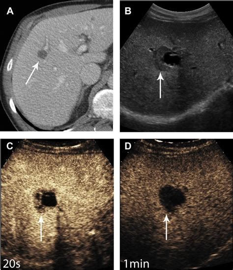 Cystic Metastasis A A Portal Venous Phase Ct Image On A Patient With