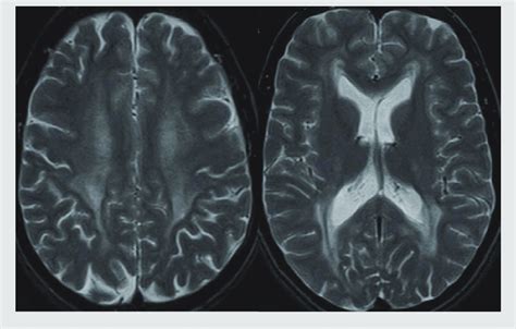 Axial T2 Weighted Mr Images Showing The Symmetrical Increase In The