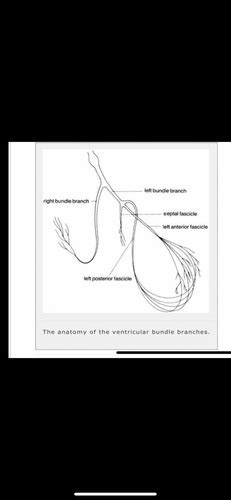 Bundle Branch Blocks Flashcards Quizlet