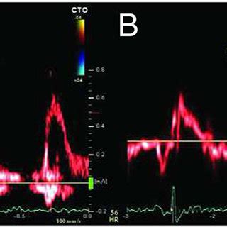 A The Mitral Inflow Pattern Shows A Deceleration Time Of 144 Ms B Download Scientific