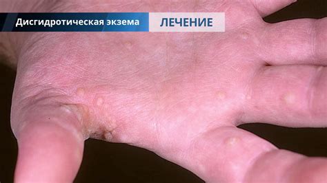 Дисгидротическая экзема лечение симптомы