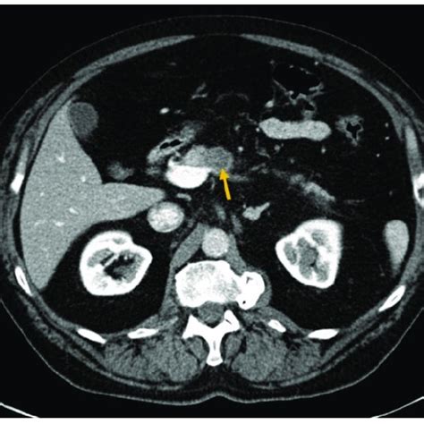 Show Examples Of Primary Tumor Detection With Detailed Information On Download Scientific