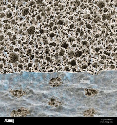 Absorbent Wound Dressing Coloured Scanning Electron Micrograph Sem