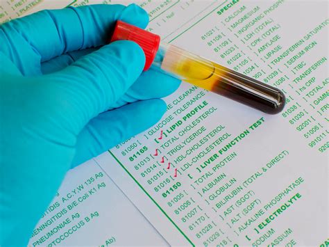 2021 Guidelines For Management Of Dyslipidemia What You Need To Know