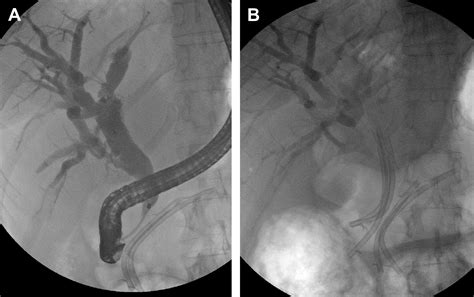 Ercp For Biliary Strictures Associated With Chronic Pancreatitis