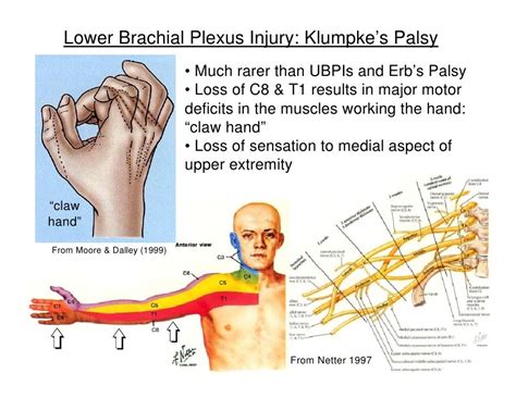 Klumpke Palsy What Is Klumpkes Palsy Symptoms Causes Diagnosis