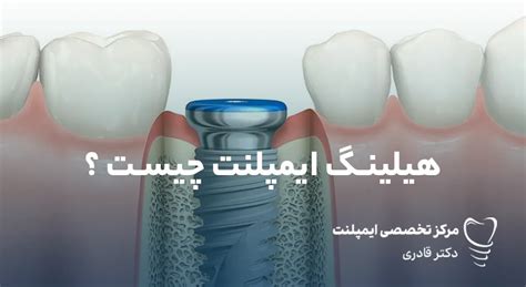 هیلینگ ایمپلنت چیست؟