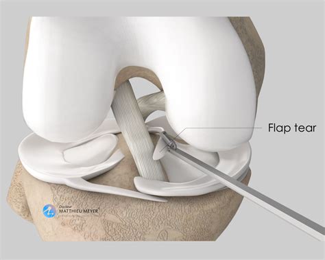 Arthroscopic Meniscal Surgery Doctor Matthieu Meyer