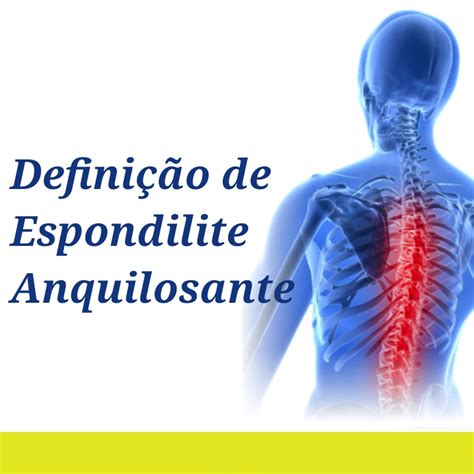 Definição De Espondilite Anquilosante Espondiloartrite Axial