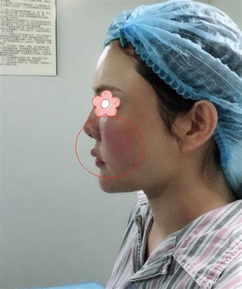 36岁美女打了生长因子，脸上长了“横肉” 知乎