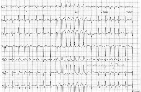 Ecg Rhythms Mat With Nsvt