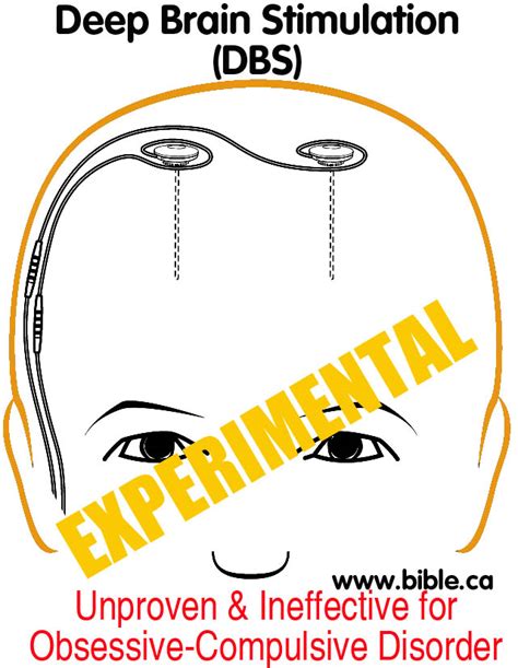 Deep Brain Stimulation DBS Mental Illness Obsessive Compulsive Disorder OCD Brain Treatments